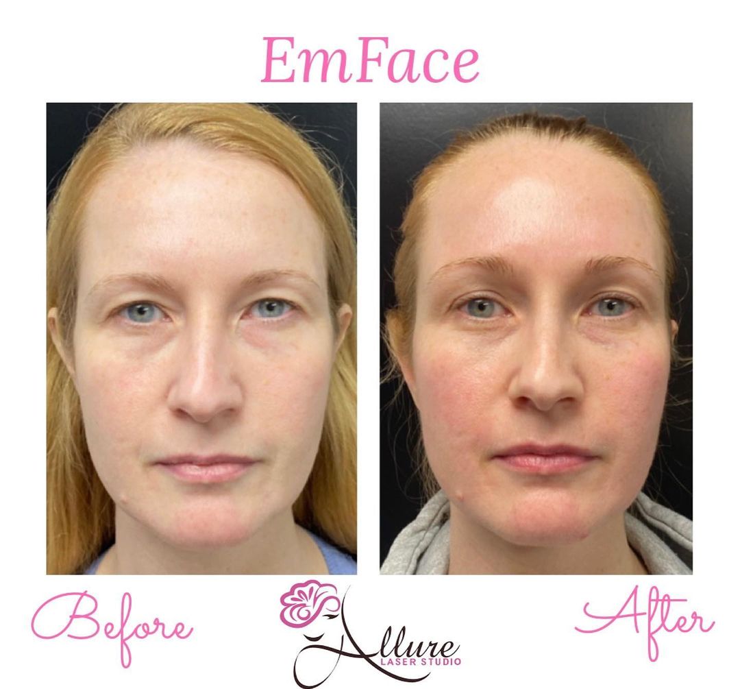 EMFACE Treatment in Houston | Allure Laser Studio
