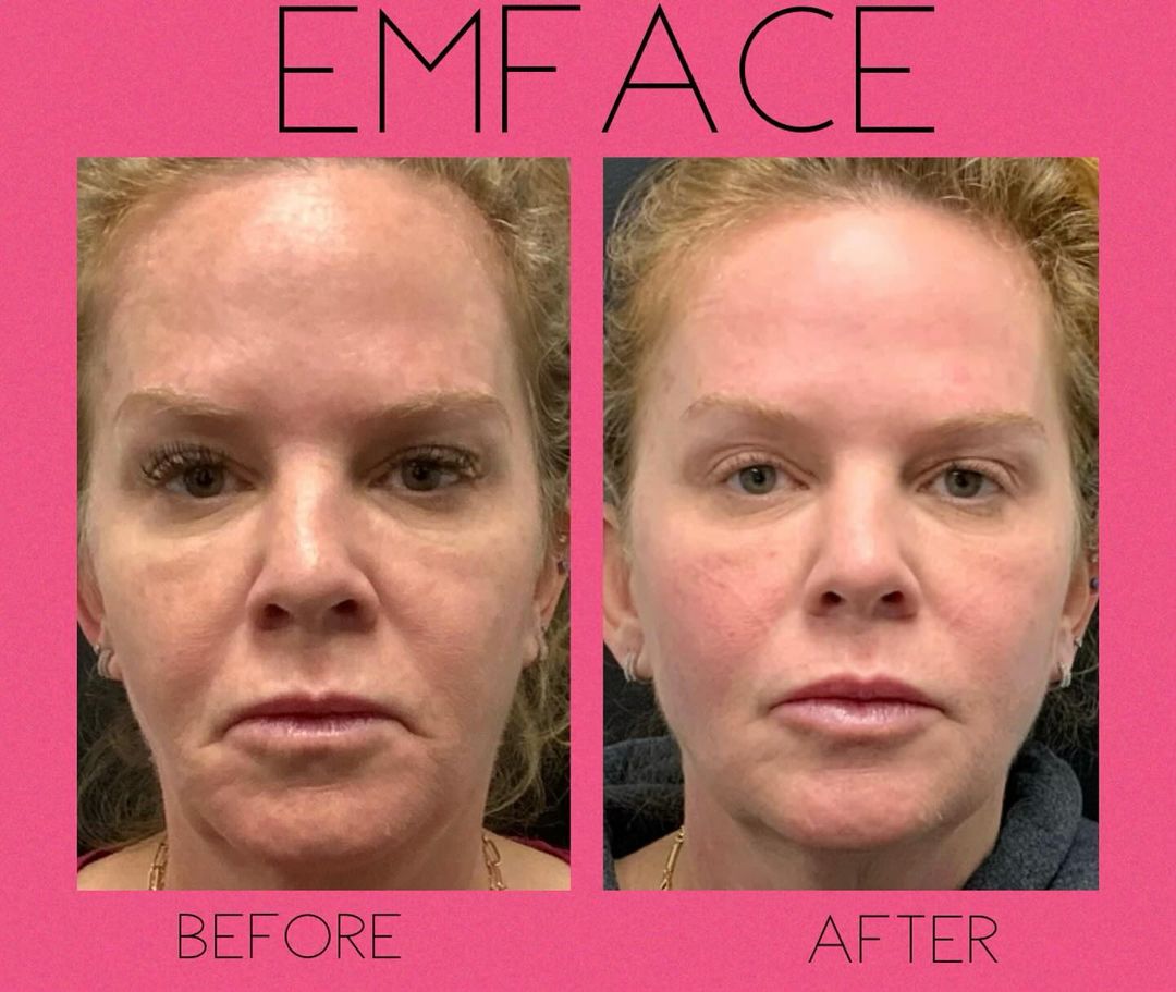 EMFACE Treatment in Houston | Allure Laser Studio
